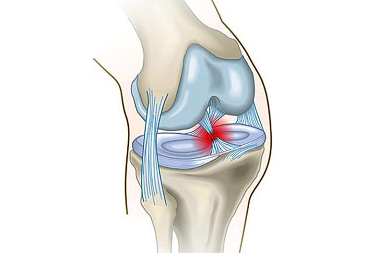 Ruptura de Ligament Incrucisat Anterior - DR. ADRIAN DIMA - Medic ...